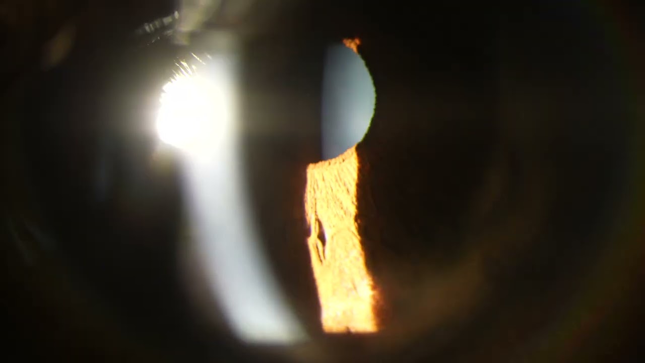 Bilateral Krukenberg Spindle