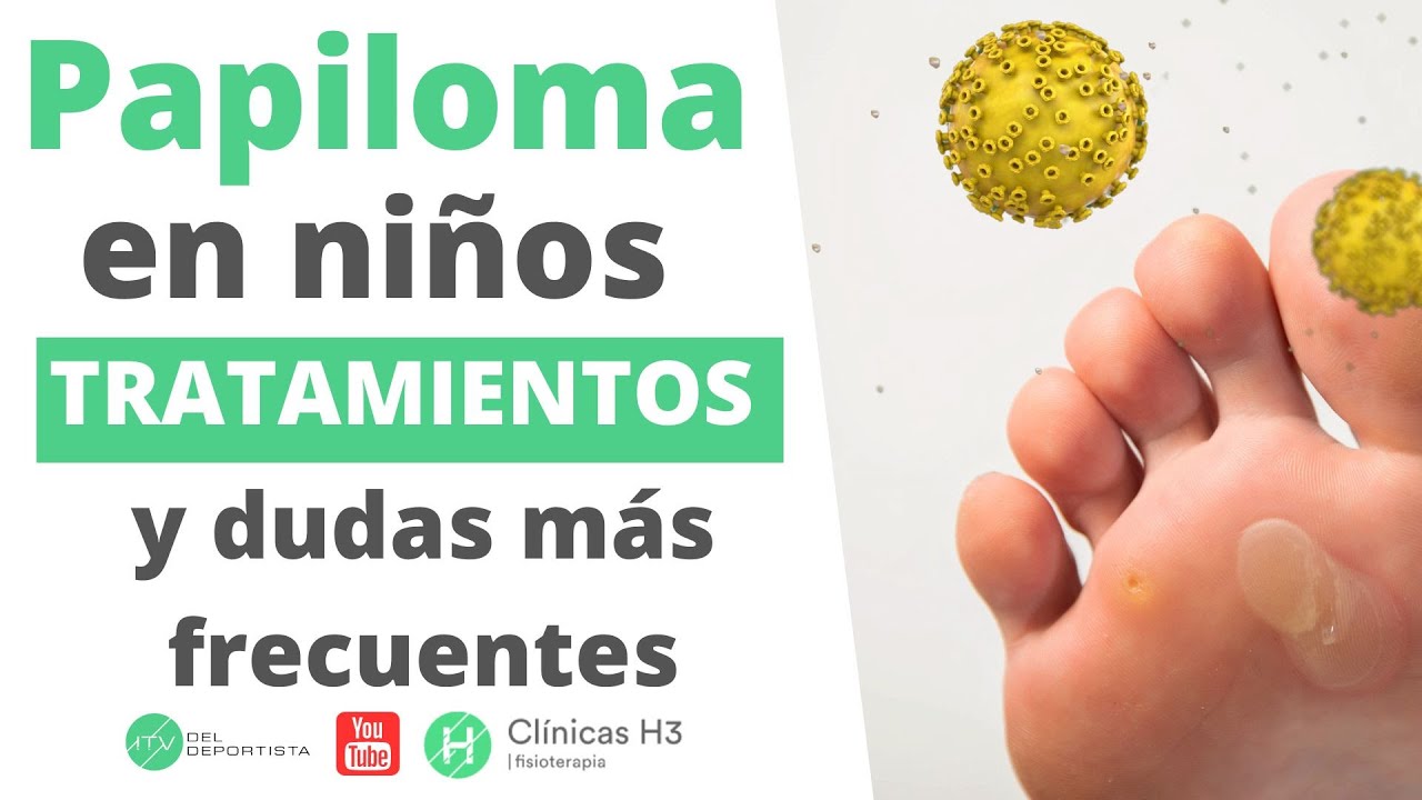Papiloma en los pies de los niños y su tratamiento en Clínicas H3 - YouTube