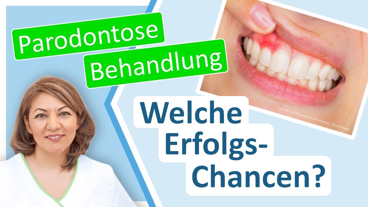Parodontose-Behandlung: Wie sind die Erfolgschancen bei einer ...