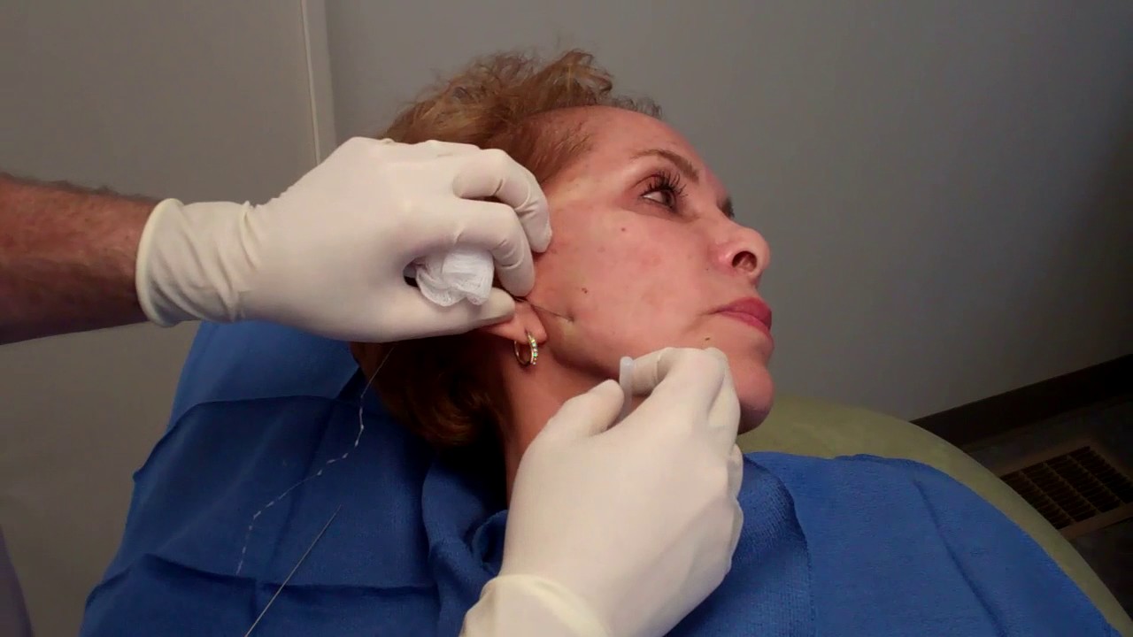 Silhouette InstaLift Threads with Dr Janowski - YouTube