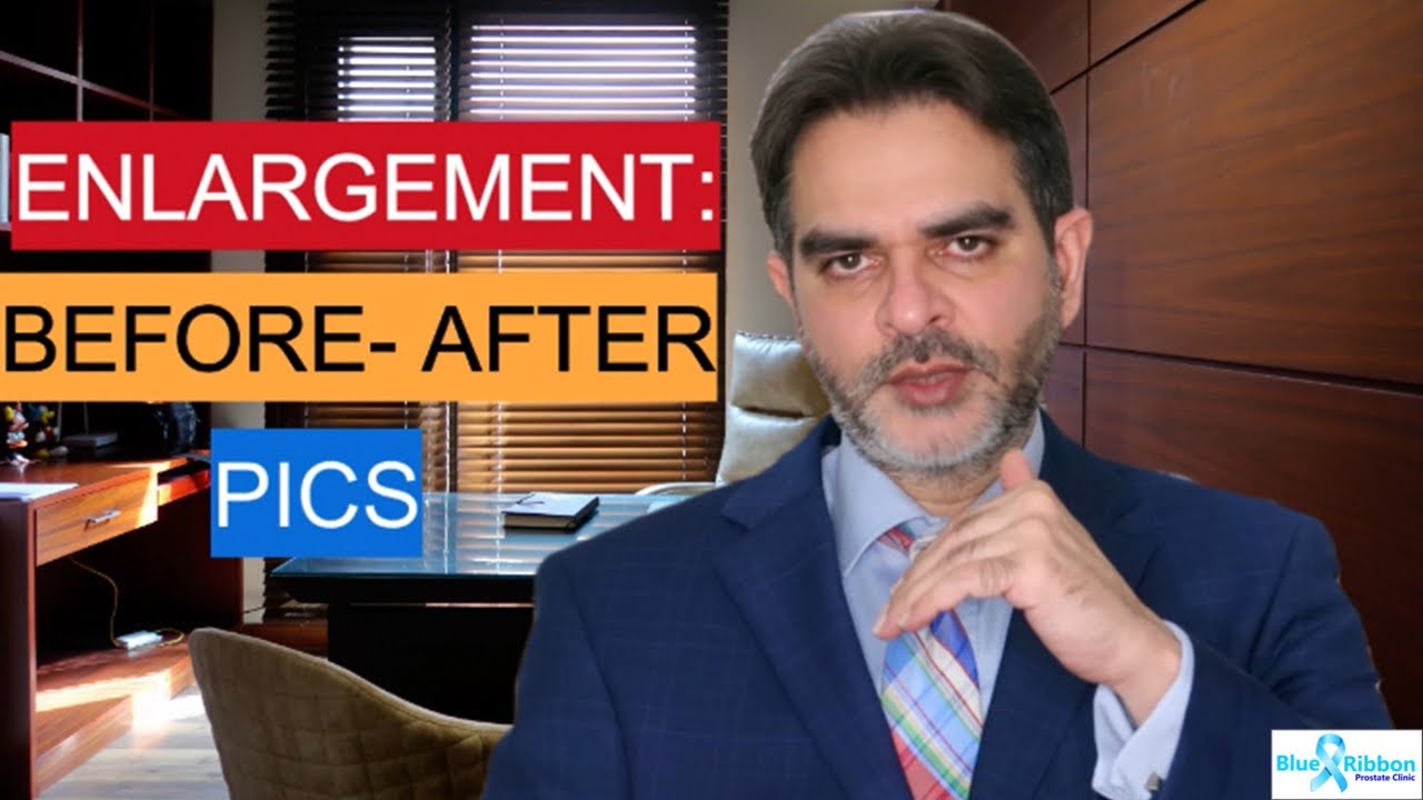 Penile Enlargement Surgery | Before-after pics length and girth ...