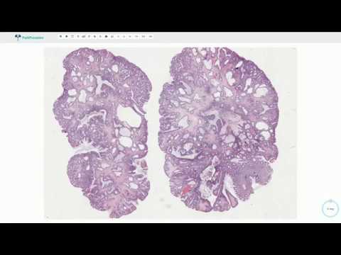 Juvenile polyp - Colon, Histopathology - YouTube