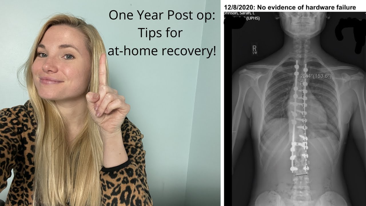 One Year Post Op | 5 Tips for Recovery at Home - YouTube