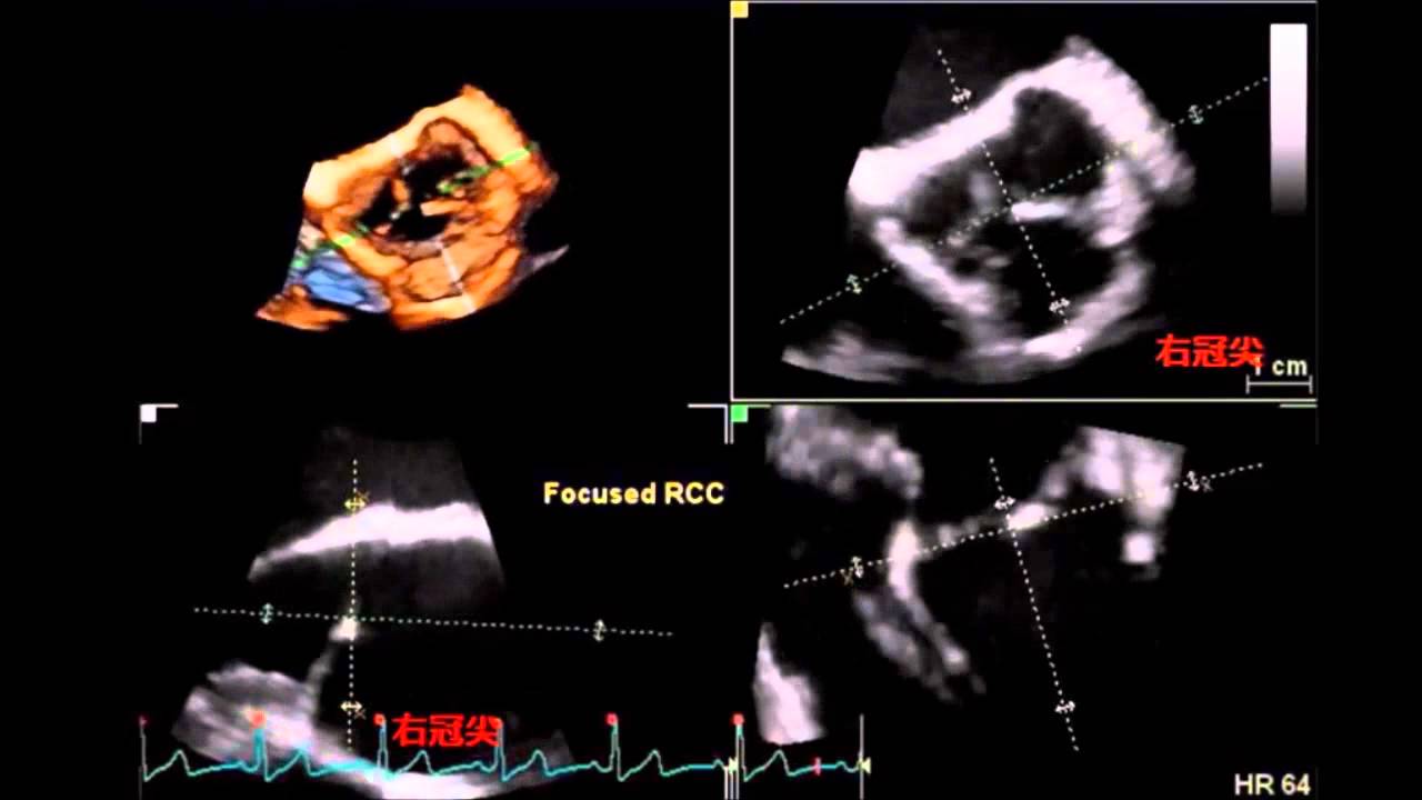 動画3 3D-TEE（MPR法）を用いたGeometric Heightの評価 - YouTube