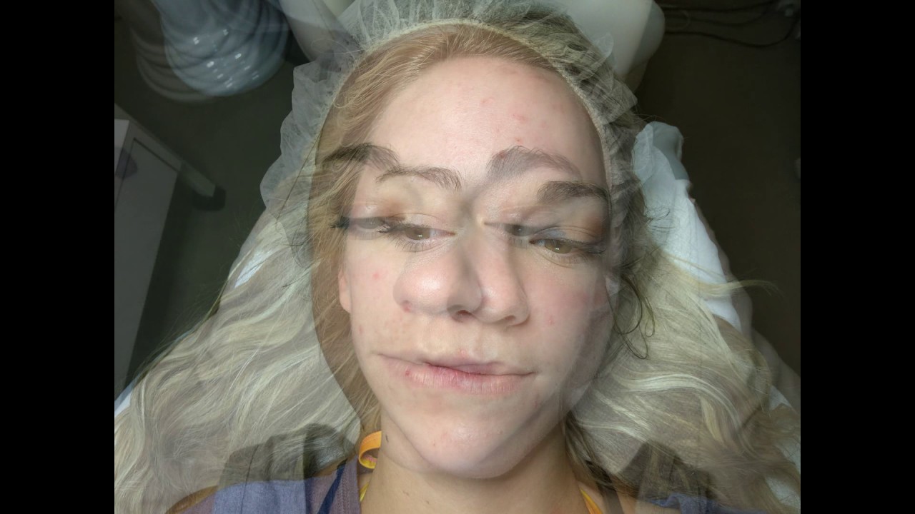 Tucson Acne Clinic - YouTube