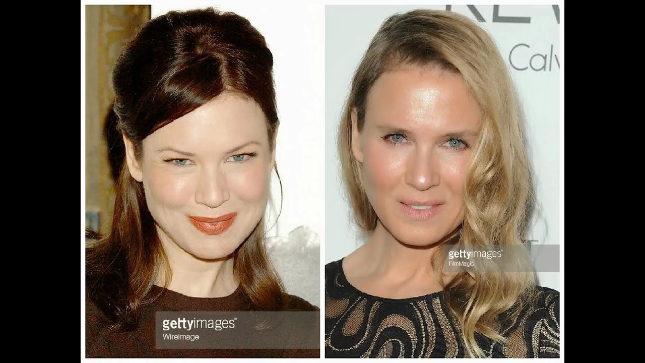 Renée Zellweger Plastic Surgery Before and After Photos - YouTube