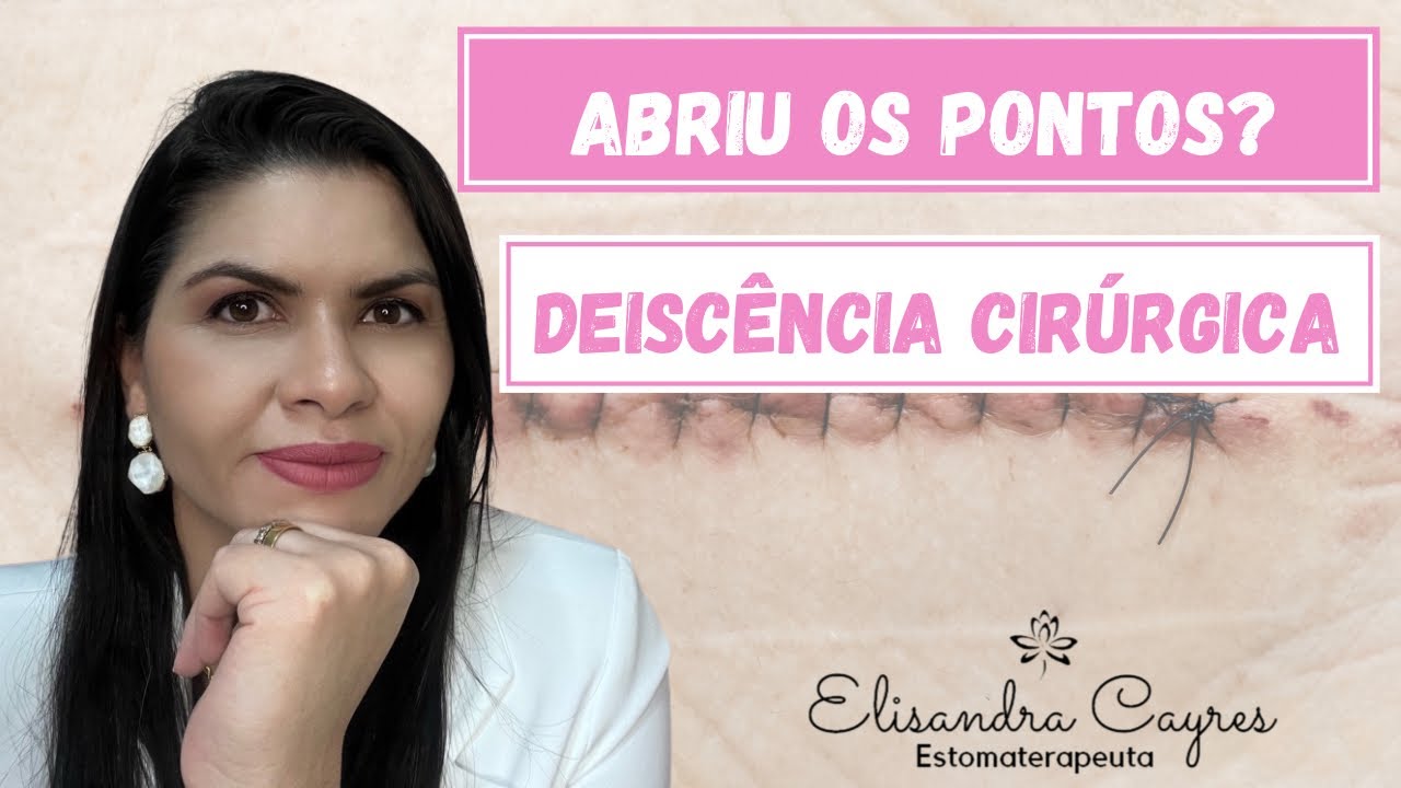 ABRIU OS PONTOS APÓS SUA CIRURGIA? DEISCÊNCIA CIRÚRGICA - YouTube