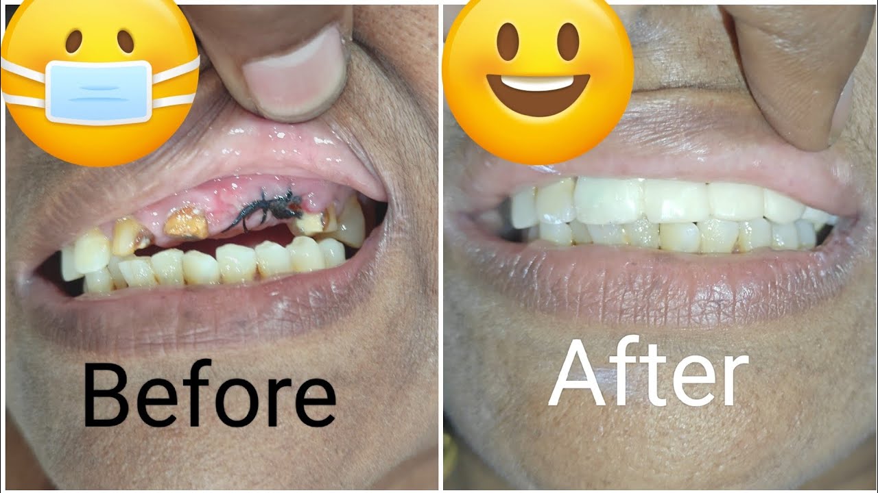 MAKING OF TEETH # (Temporary teeth preparation)😬 - YouTube