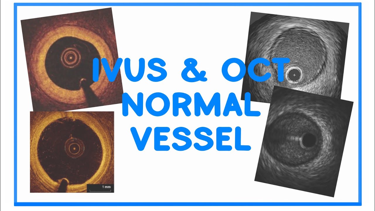 HOW to identify NORMAL IVUS and OCT imaging! - YouTube