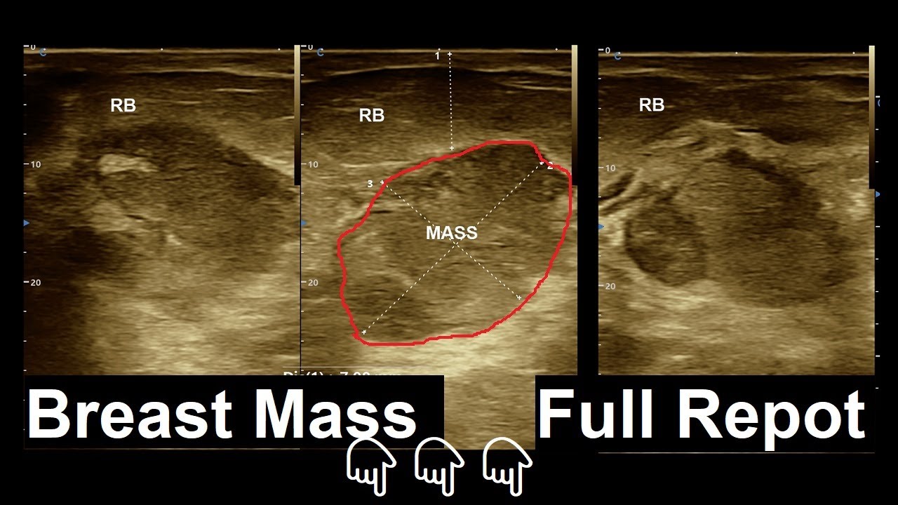 Another type of Breast mass || Ultrasound || Report || Amader hospital ...