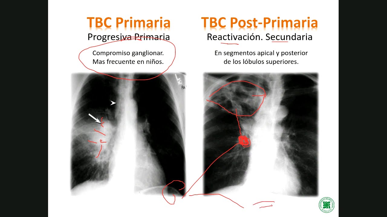 Terapéutica Médica - Manejo de la Tuberculosis 1/1 (Opción 2) - YouTube