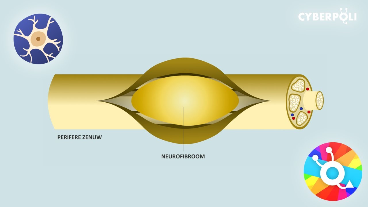 Plexiform neurofibroom (NF1, Neurofibromatose) - YouTube
