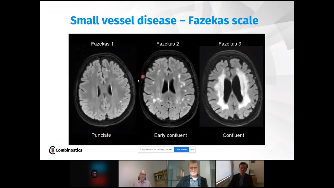 Dementia MRI interpretation - towards quantitative assessments - YouTube