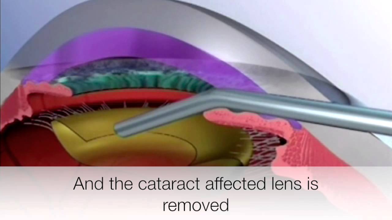 Cataract Surgery - YouTube