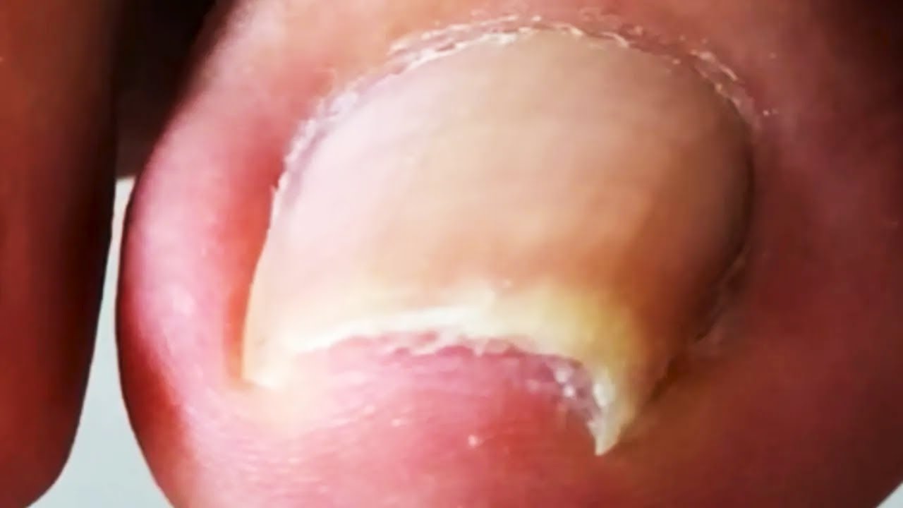 Sharp And Protruding Ingrown Nails, Professional Trimming - YouTube