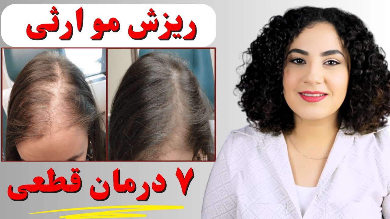 درمان ریزش مو ارثی و هورمونی Youtube