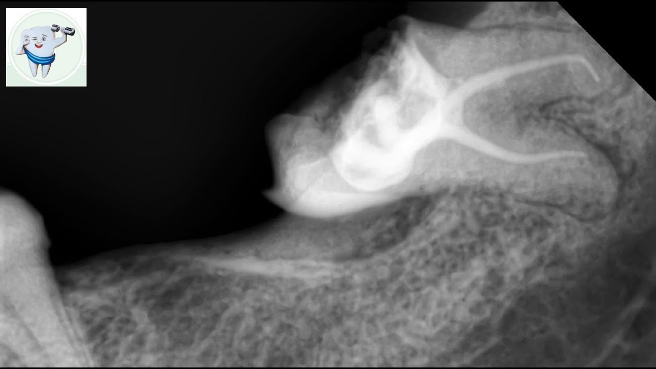 Root Canal Treatment cases in 5 minutes | 100 X-Ray Images - YouTube