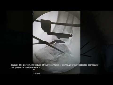 INFINITY TOTAL ANKLE SISTEM WITH PROPHECY ALIGNEMENT GUIDES WITH RESECT ...