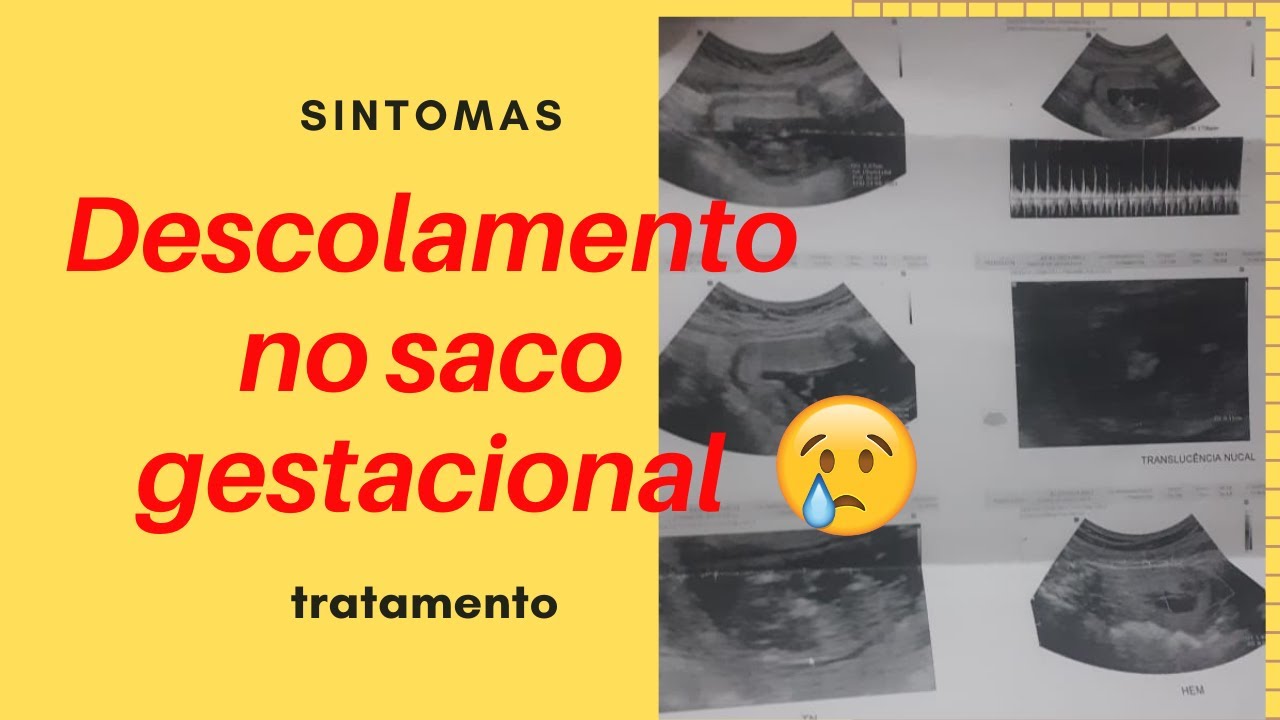 Descolamento De Saco Gestacional - BRAINCP