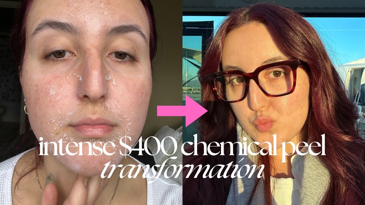 THIS WEEK WAS ROUGH: INTENSE CHEMICAL PEEL | Derma Peel Daily Updates ...