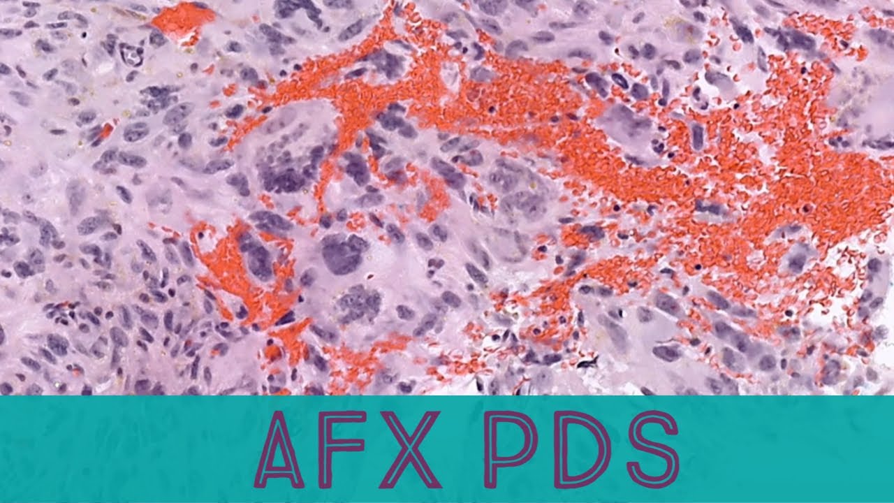 AFX & PDS (atypical fibroxanthoma & pleomorphic dermal sarcoma ...