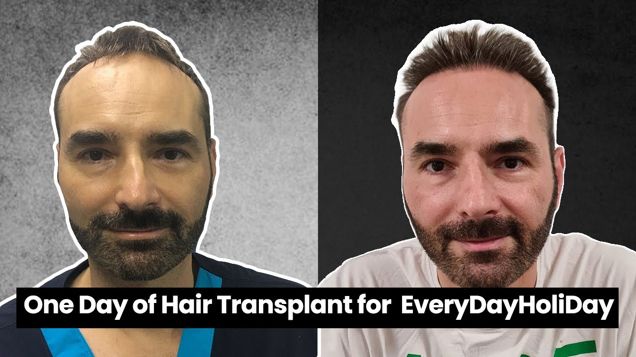 One Day of Hair Transplant for @EveryDayHoliDay / Adrian Moldovan Hair ...