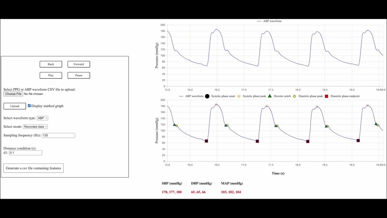 Detection of Dicrotic Notch in Arterial Pressure and Photoplethysmography Signals - YouTube