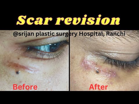 Scar revision surgery - Result after 1 week | Laser scar revision ...