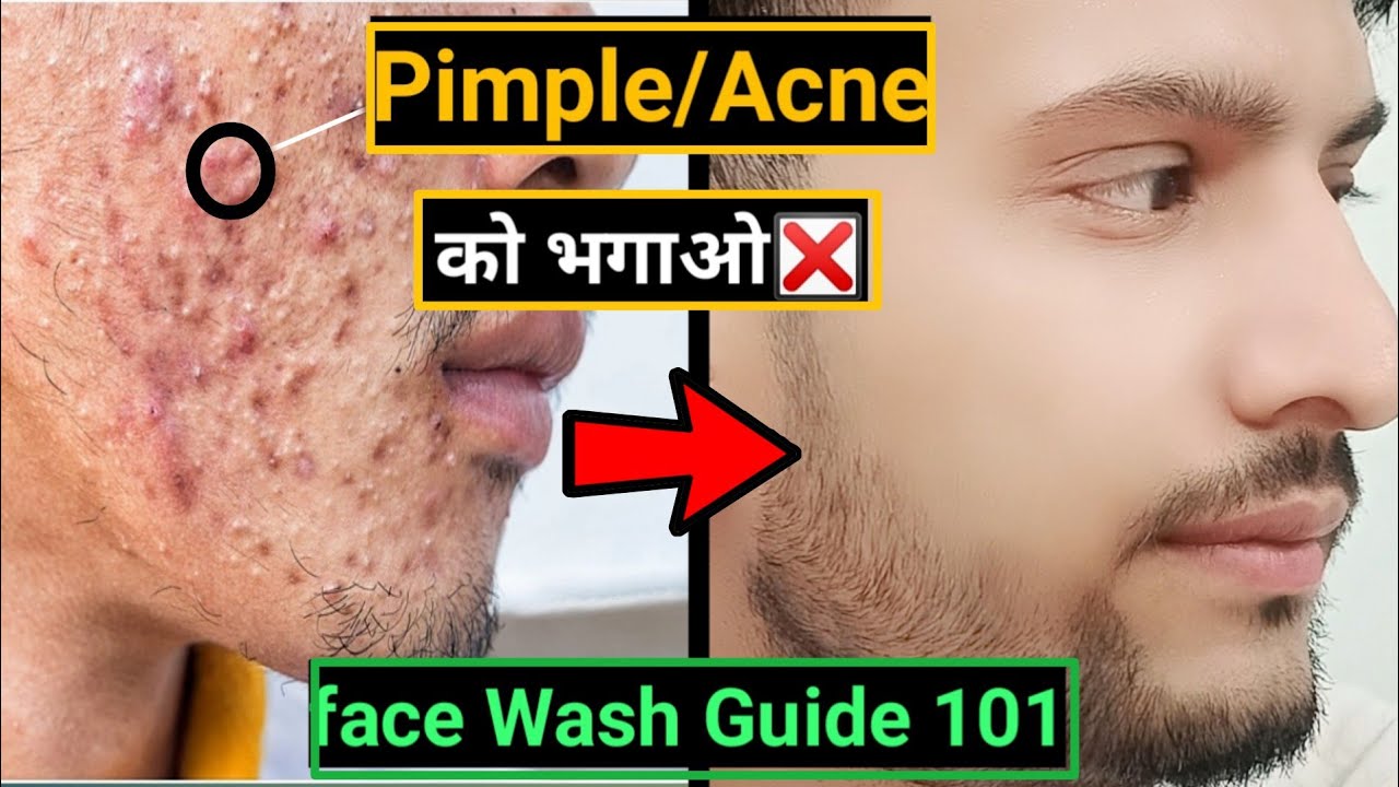 चेहरा साफ कैसे करें-Pimple Fighting Face Wash Technique|pawan yudi ...