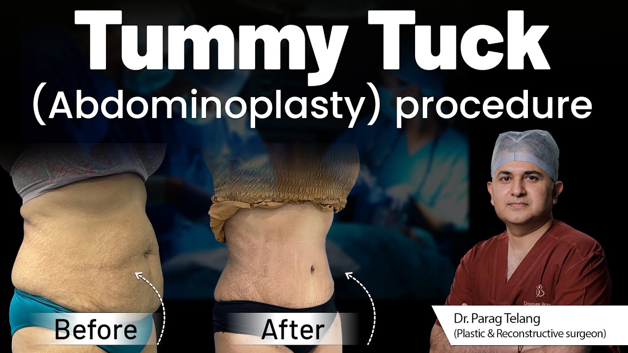 Tummy Tuck complete procedure | Dr. Parag Telang | Tummy Tuck surgery ...