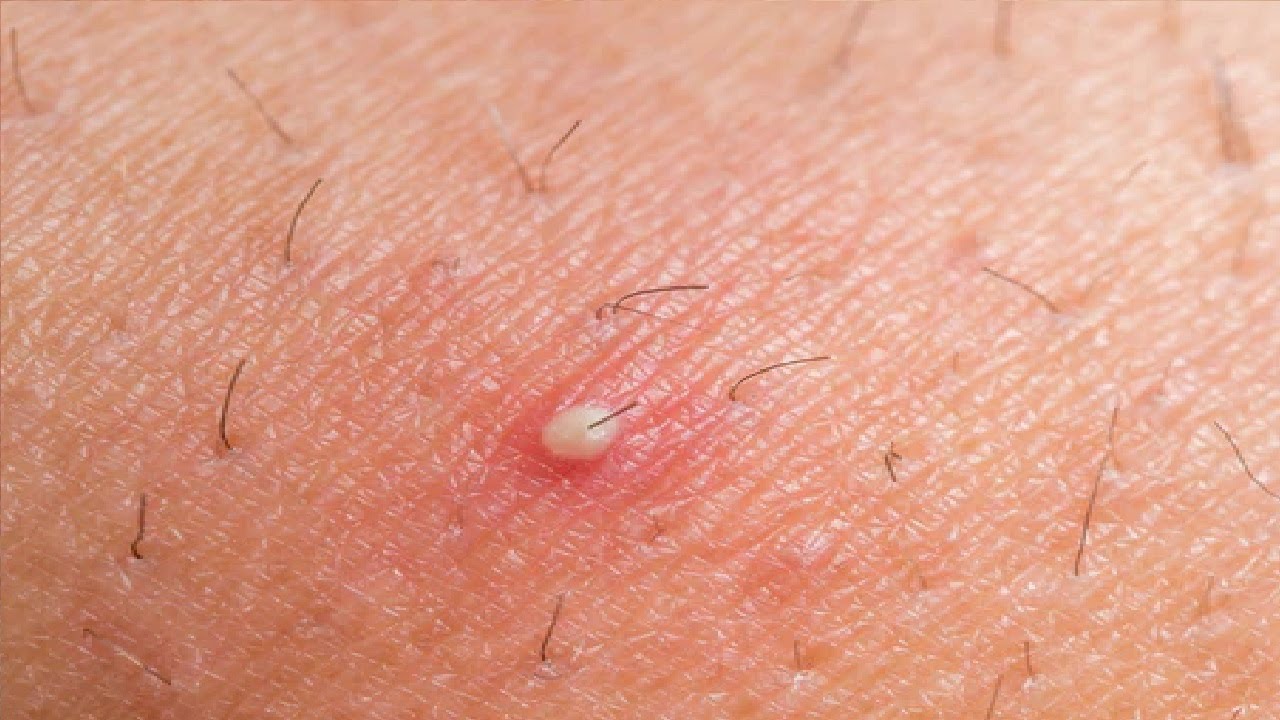 how to get rid of an ingrown hair cyst naturally at home - YouTube