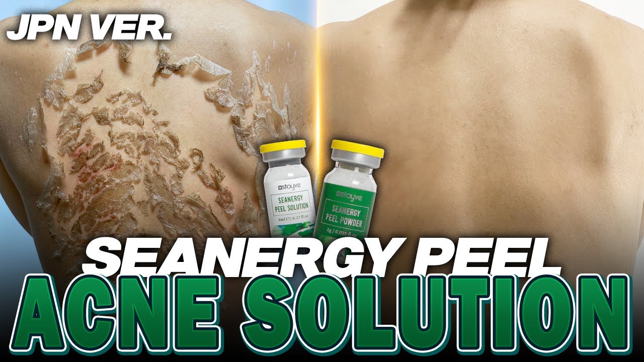 Back Acne Gone in 15 Days! The Ultimate Exfoliation Program(JPN ver. ️ ...