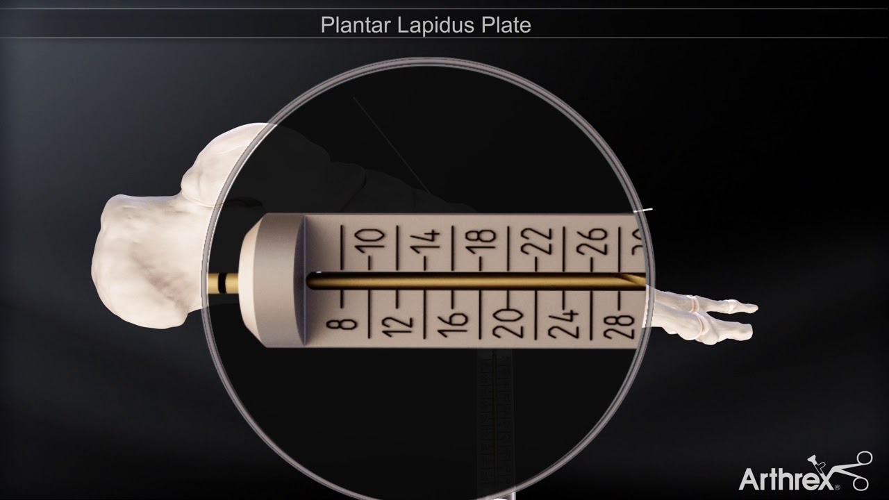 Plantar Lapidus Plantar Plate - YouTube