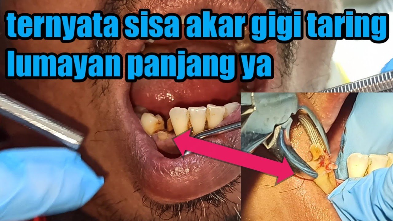 pencabutan sisa akar gigi taring bawah lumayan bikin ndredeg - YouTube