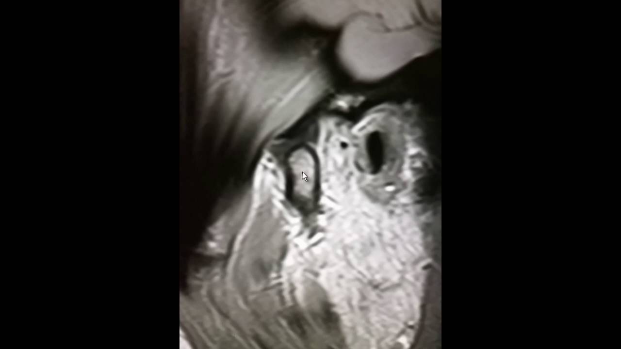 Normal TMJ at MRI - YouTube