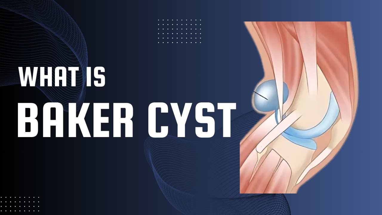 How to ACTUALLY Treat a Baker's Cyst (Pain Behind Knee) #kneepain - YouTube