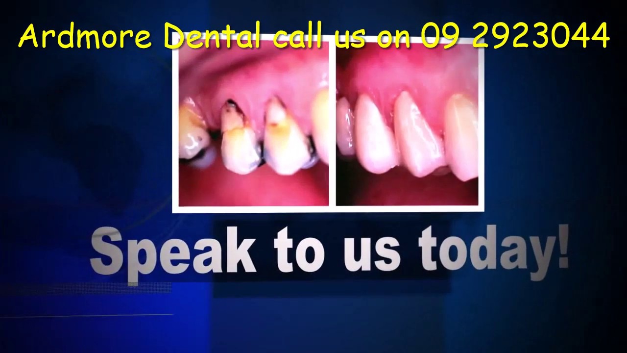 Ardmore Dental side filling/cervical filling - YouTube