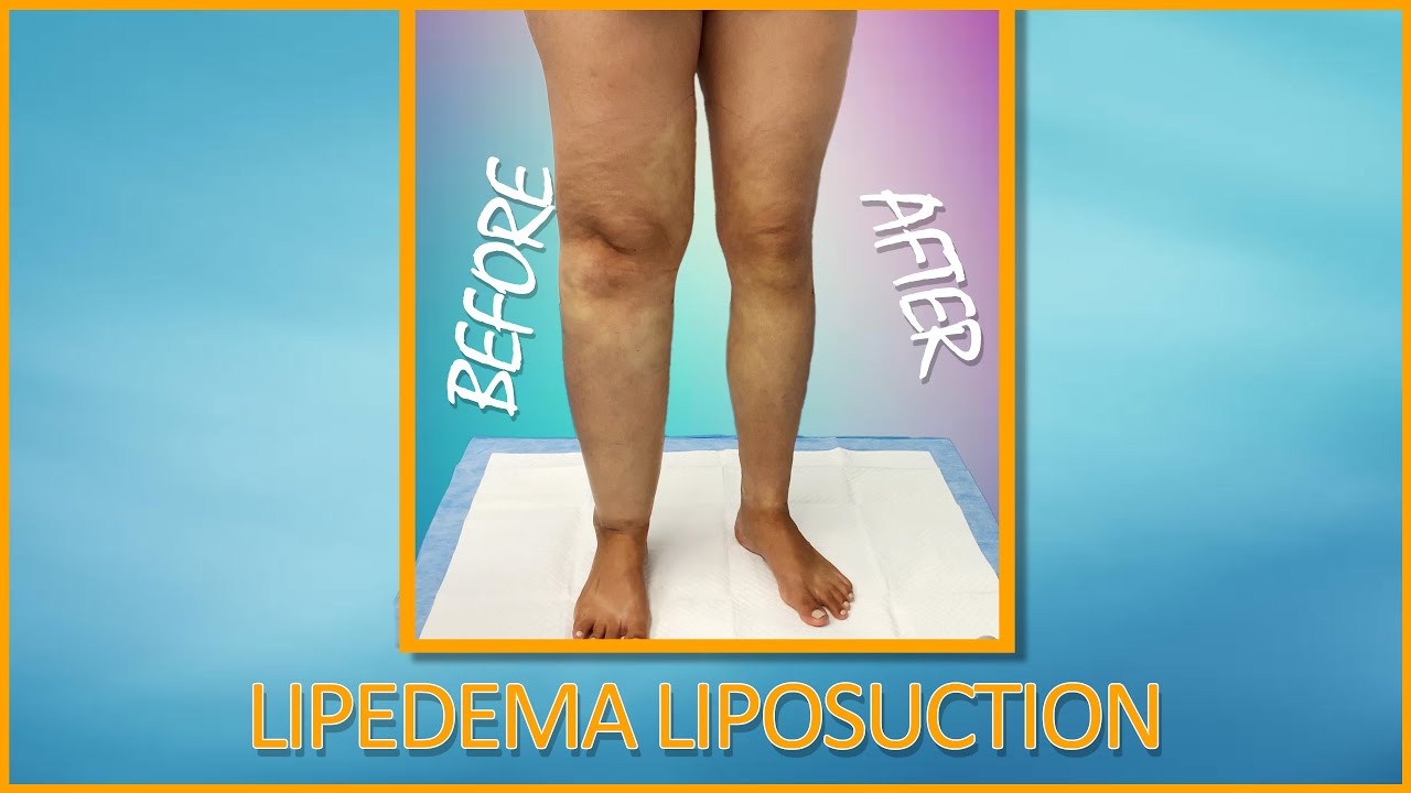 Lipedema | Leg Liposuction Surgery Results | Lipo 360° Legs | Cankles ...