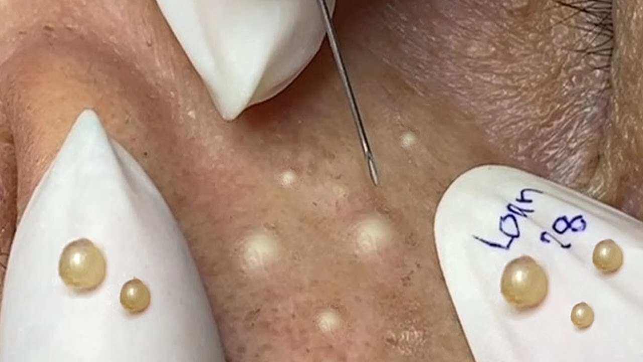 Big Cystic Acne Blackheads Extraction Blackheads & Milia, Whiteheads ...