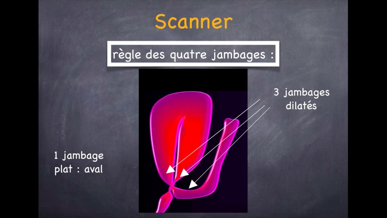 Occlusion intestinale - 4. Occlusion colique - YouTube