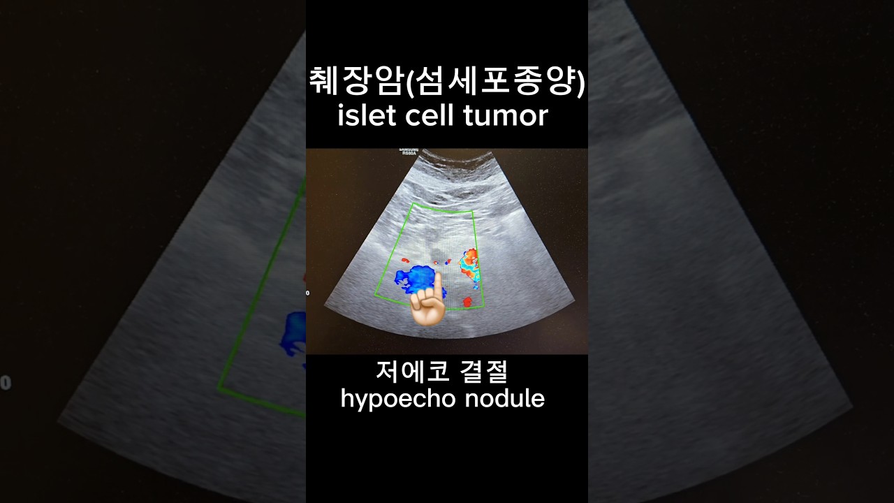 췌장암 | pancreas cancer | 섬세포종양 | islet cell tumor #췌장암 #섬세포종양 #pancreas ...