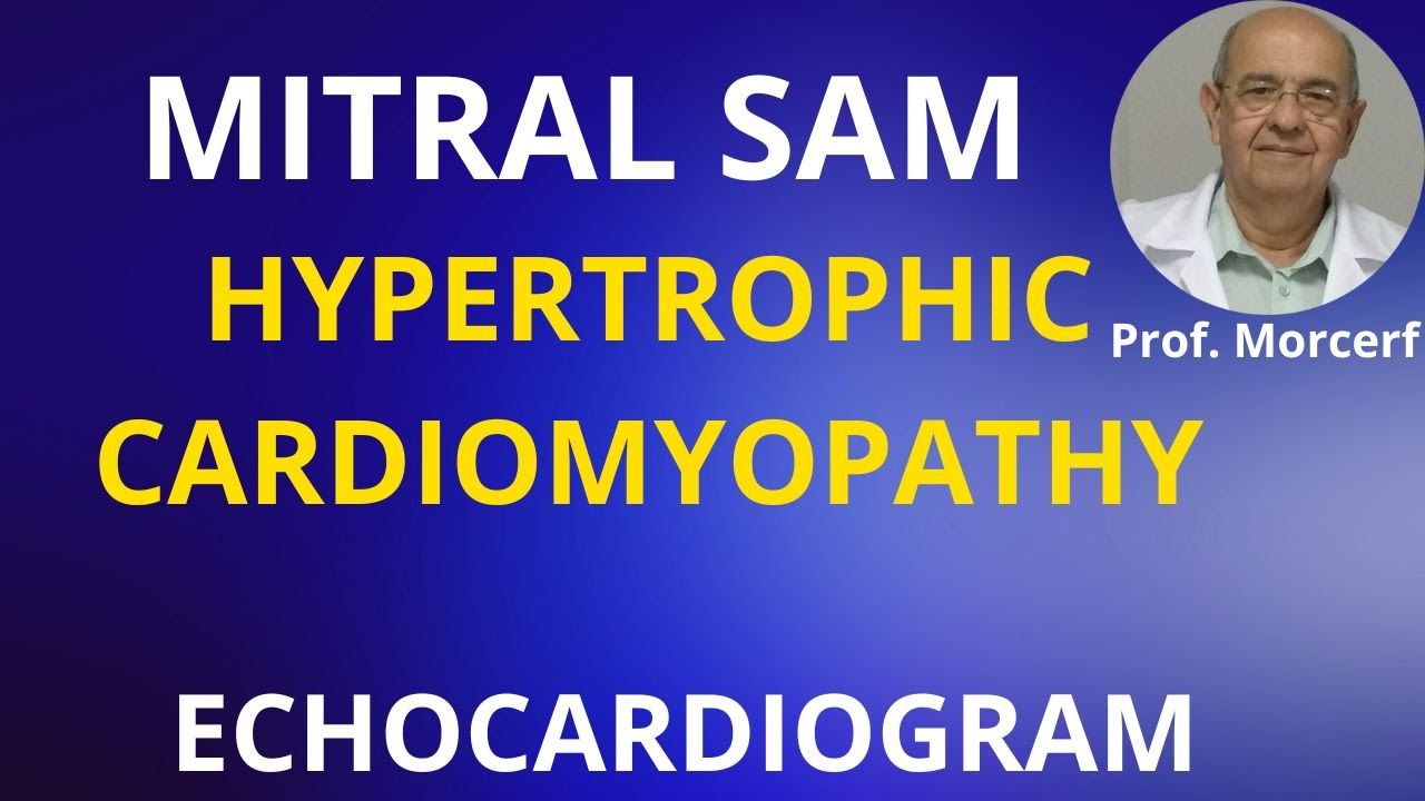All the Secrets of Mitral SAM. Leaflet or Chords? - YouTube
