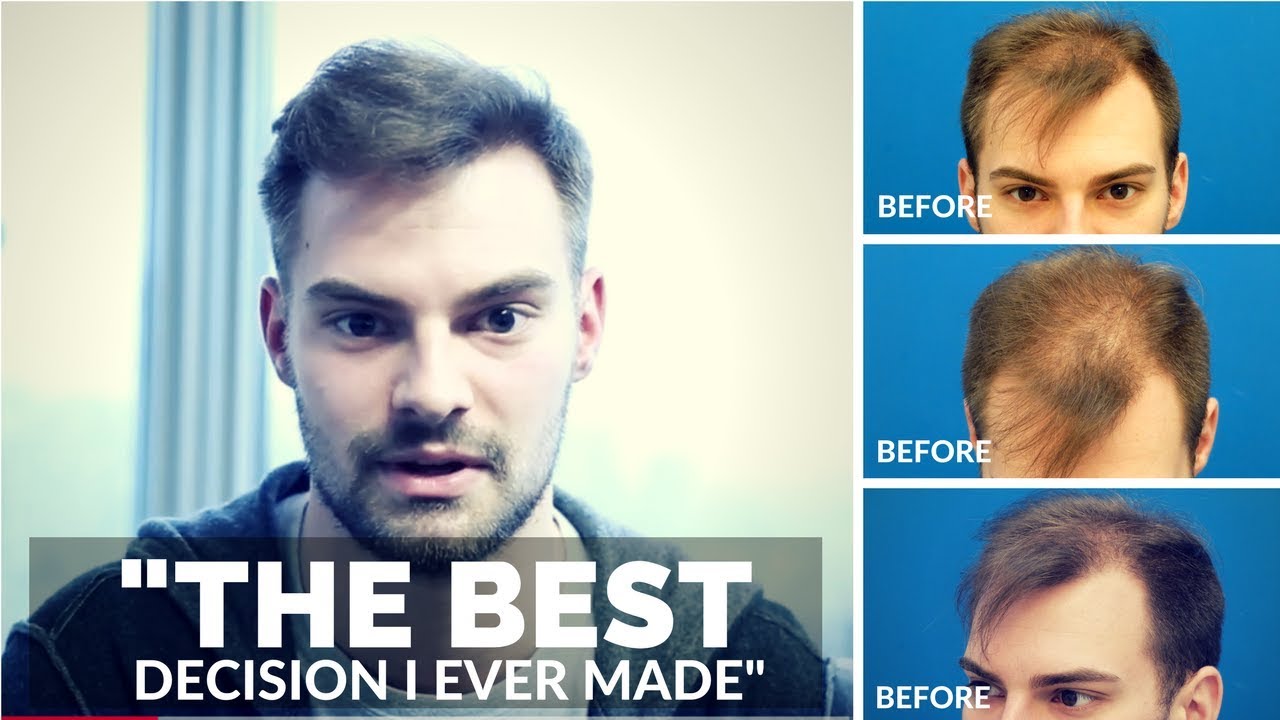 Hasson And Wong Reviews | 4,975 Grafts Hair Transplant - YouTube