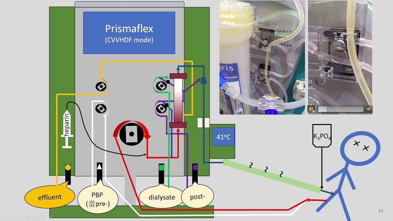 Prismaflex CVVHDF原理 - YouTube