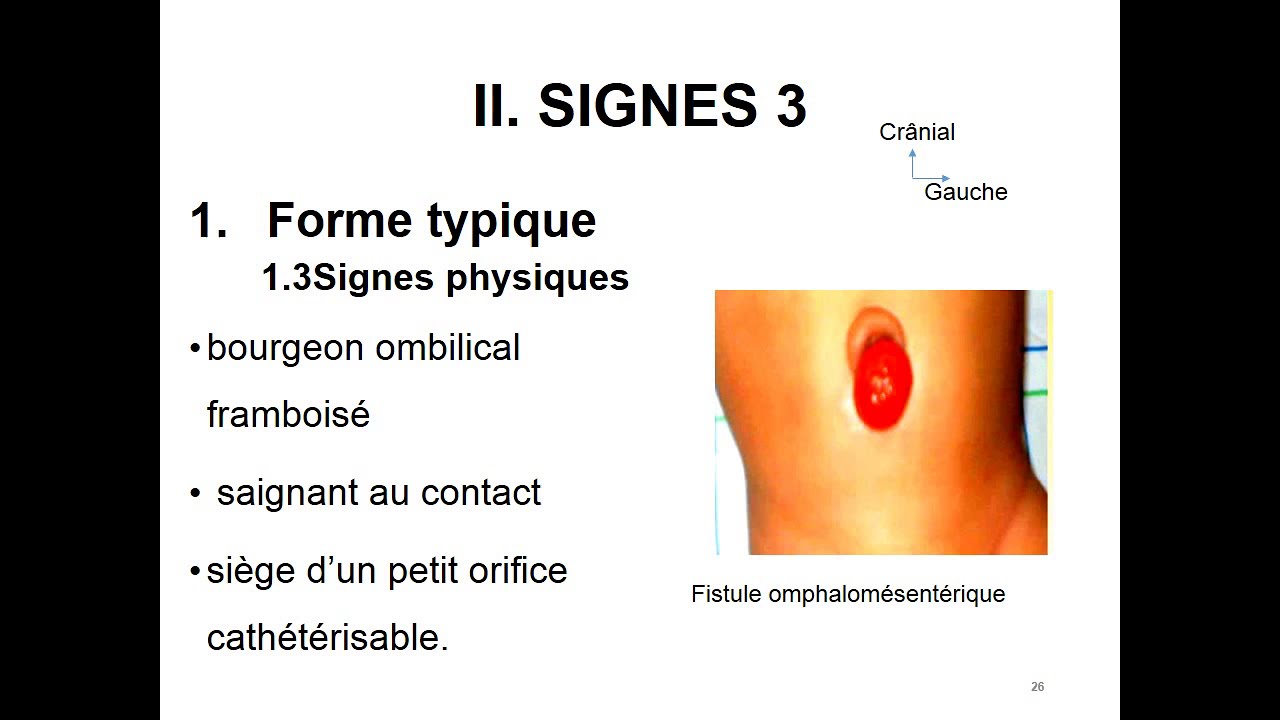 Pathologie du canal omphalo mésentérique, cours Dr KOUNA TSALA - YouTube