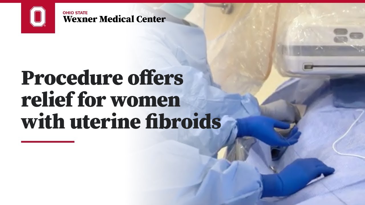 Procedure offers relief for women with uterine fibroids | Ohio State ...