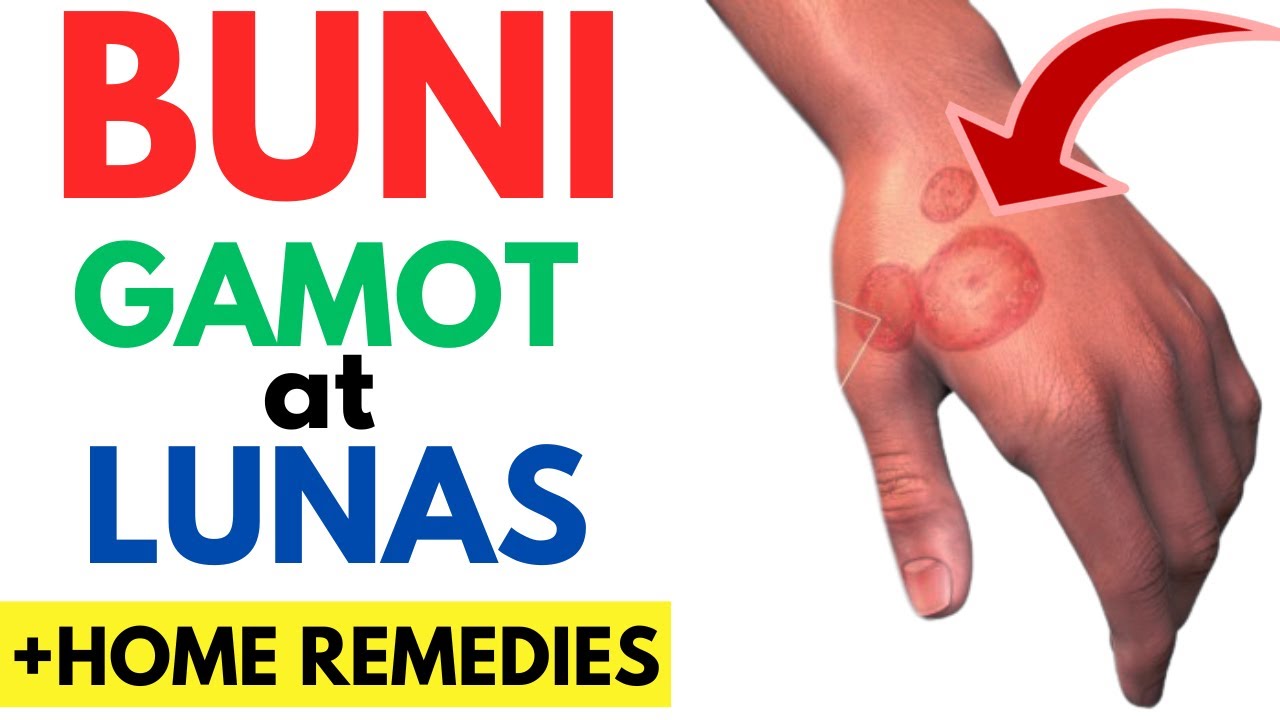 Gamot at Lunas sa BUNI | Sanhi, Sintomas ng BUNI sa BALAT | Home ...