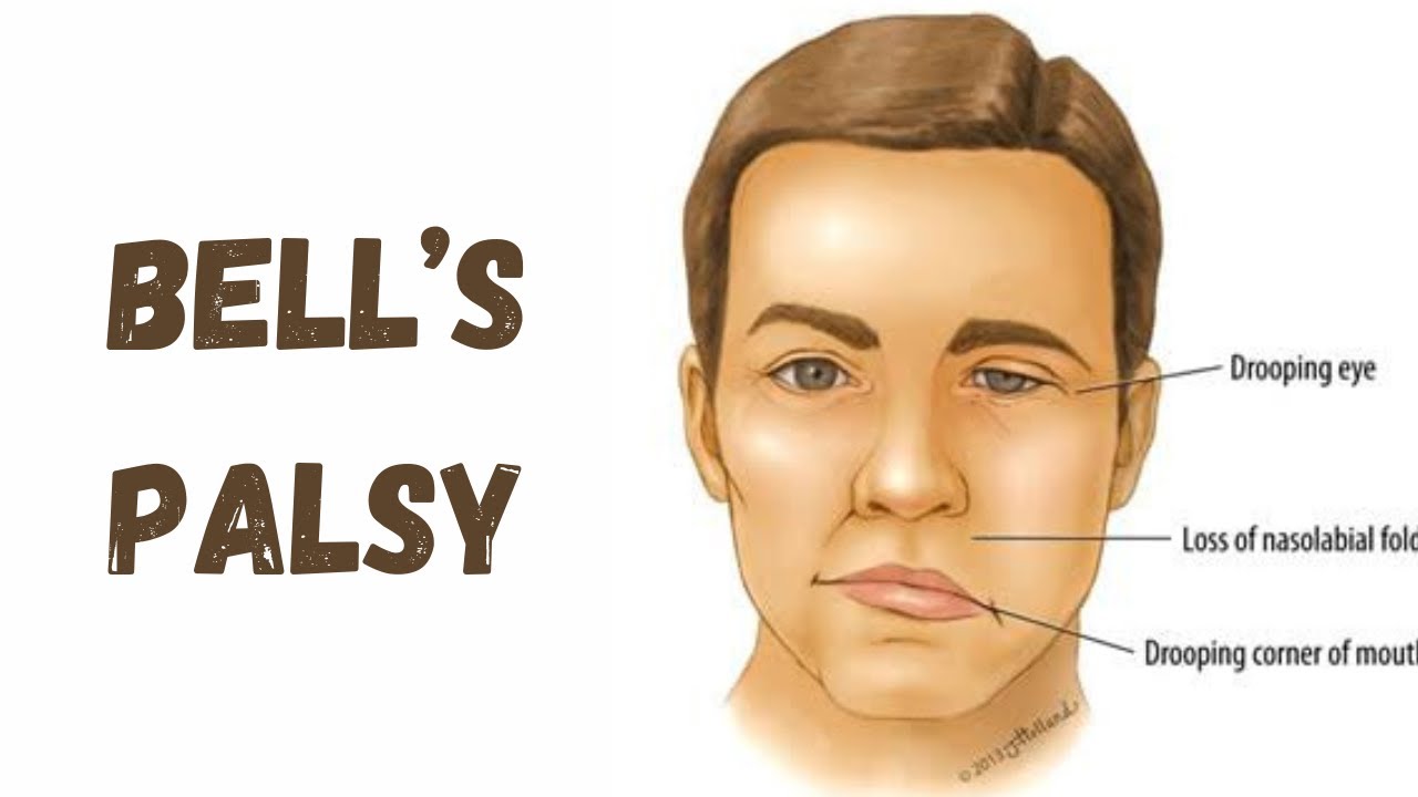 BELL’s PALSY | Facial Nerve And it’s Disorders Part 4 - YouTube