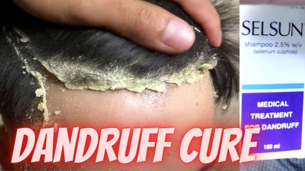 How to cure dandruff Selsun dandruff shampoo review - YouTube