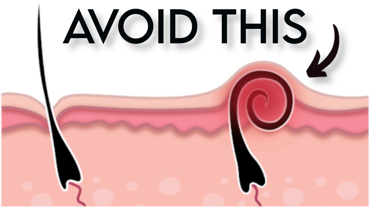 Avoid Ingrown Hairs For good!!! - YouTube